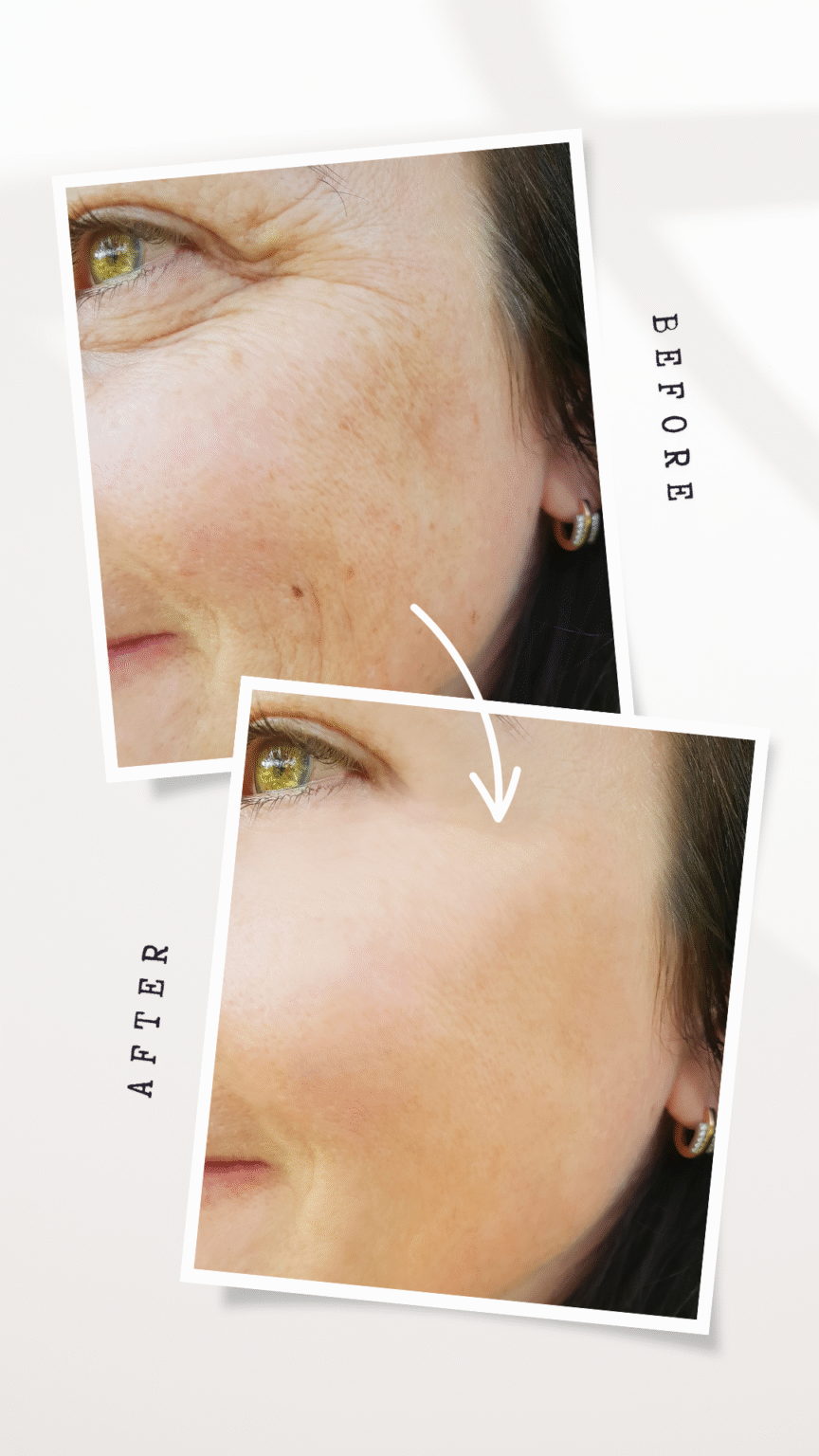 HIFU Before and After Results | Real Client Transformations